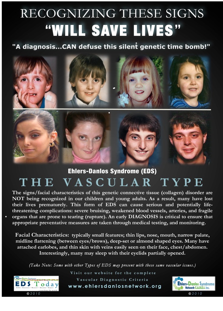 A Simple Guide to The Ehlers Danlos Syndromes | The Zebra Mom